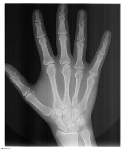 Die Handröntgenaufnahme in der Kieferorthopädie ist obsolet | Dr. Madsen