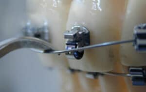 Selbstligierende Brackets | Dr. Madsen