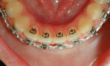 Zungenspikes-Kieferorthopäde | Dr. Madsen